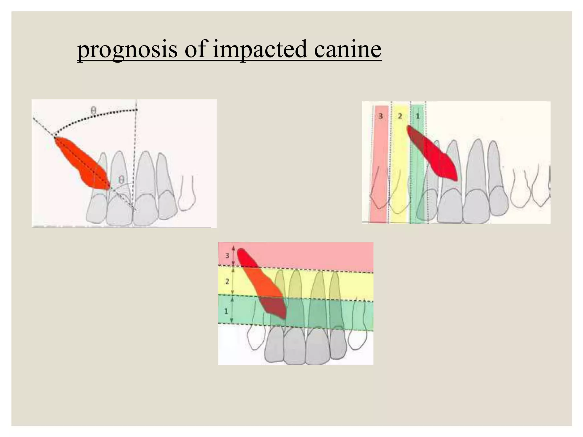 orthodontic management of impacted canine. | PPTX