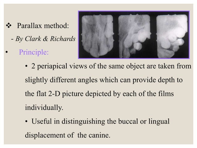 orthodontic management of impacted canine. | PPTX