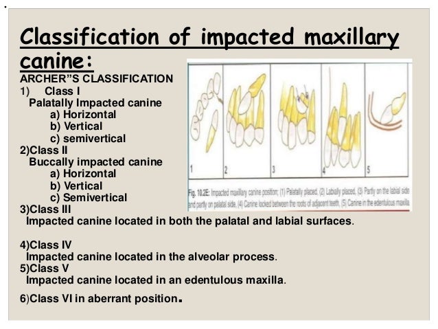 orthodontic management of impacted canine.
