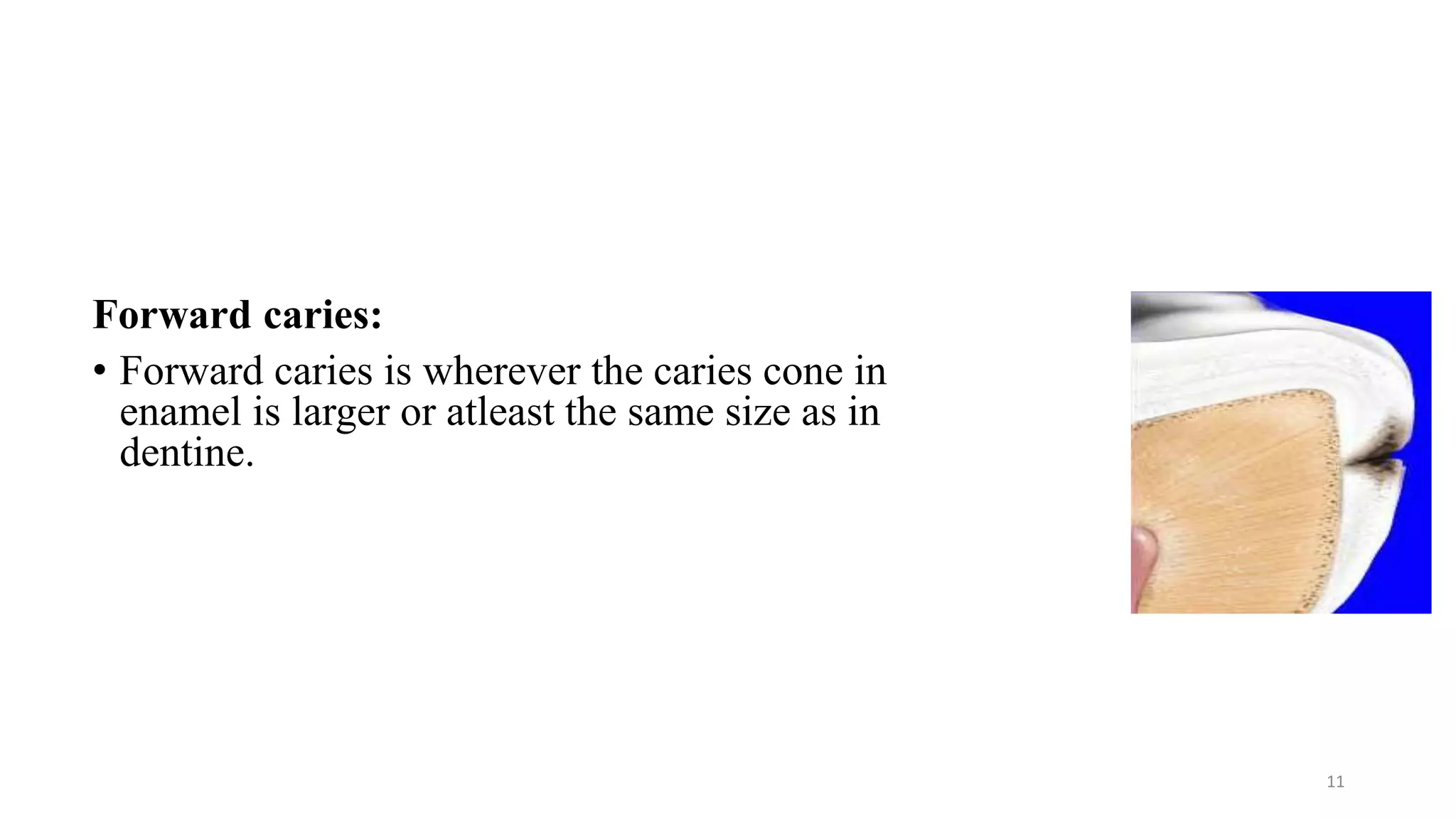 dental caries classifications, histopathology | PPTX