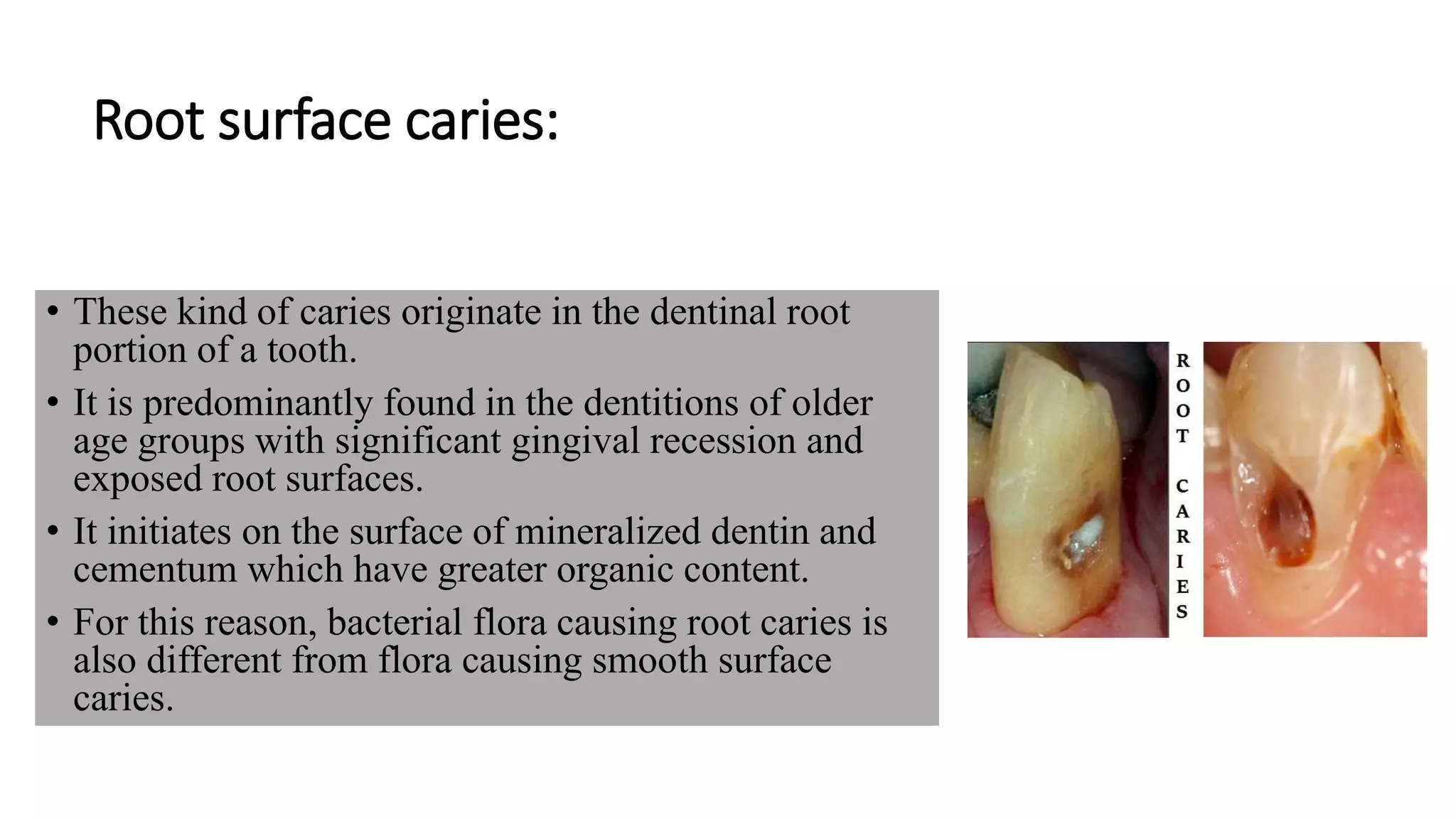 dental caries classifications, histopathology | PPTX