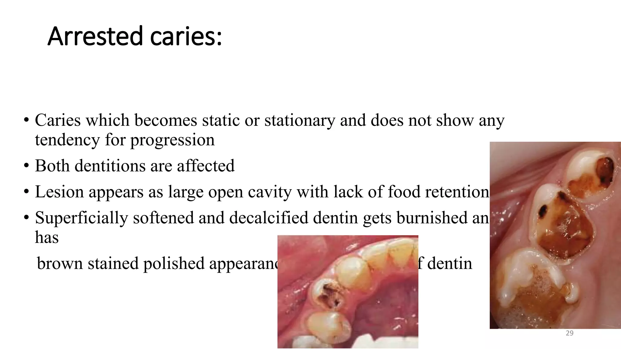 dental caries classifications, histopathology | PPTX