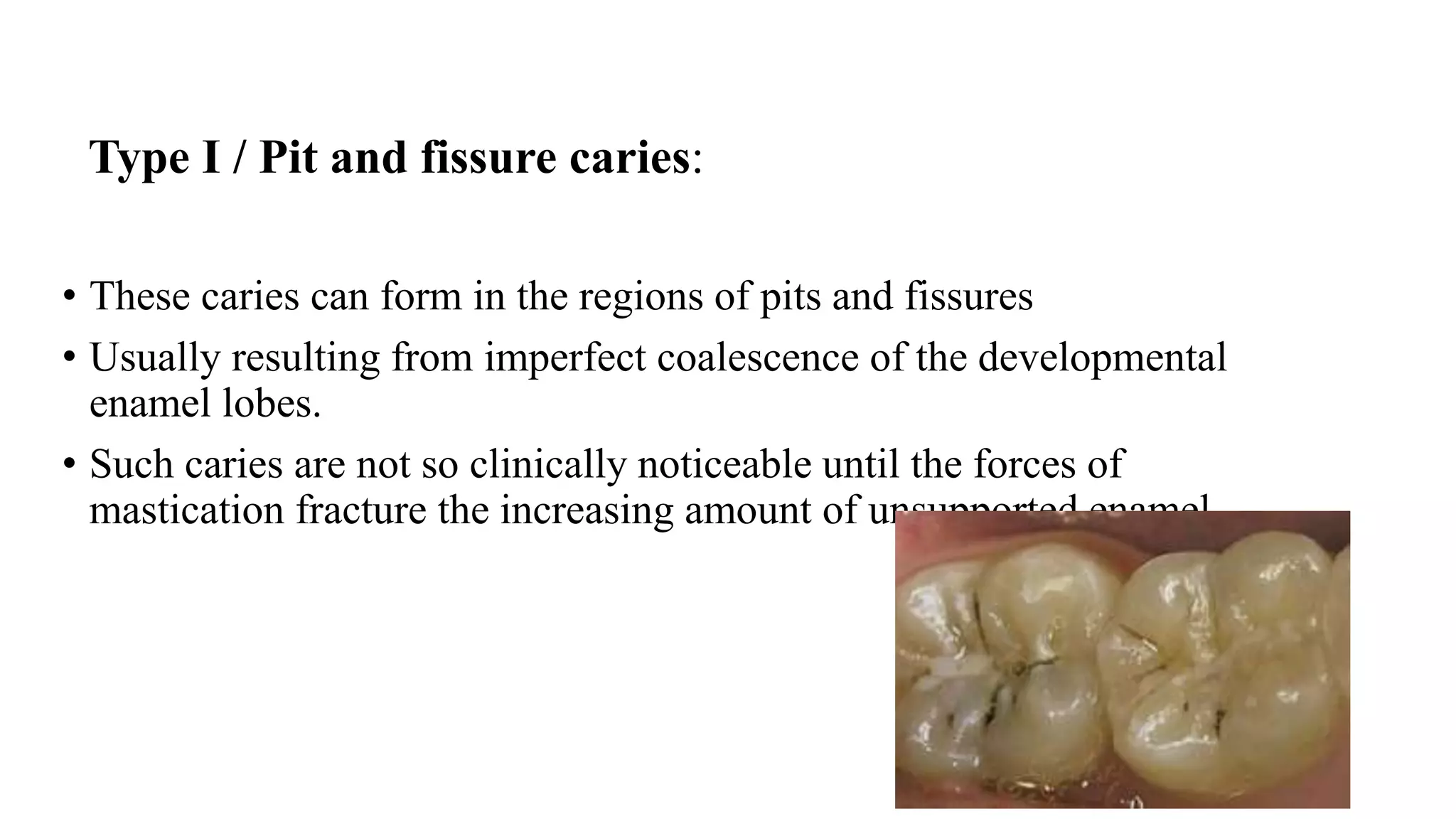 dental caries classifications, histopathology | PPTX