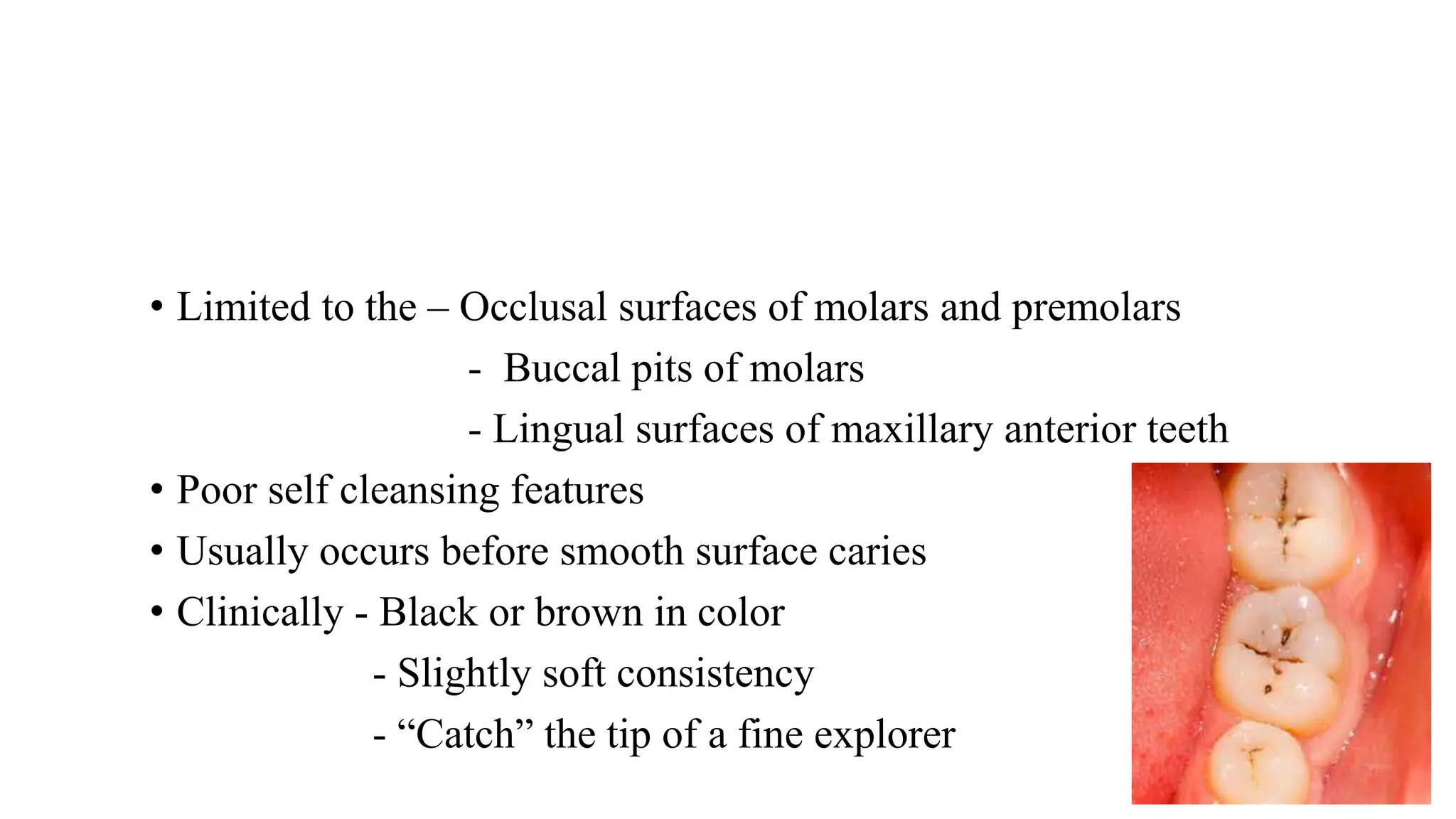 dental caries classifications, histopathology | PPTX