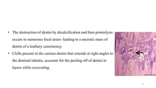 dental caries classifications, histopathology | PPTX