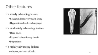 dental caries classifications, histopathology | PPTX
