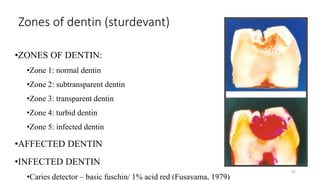 dental caries classifications, histopathology | PPT