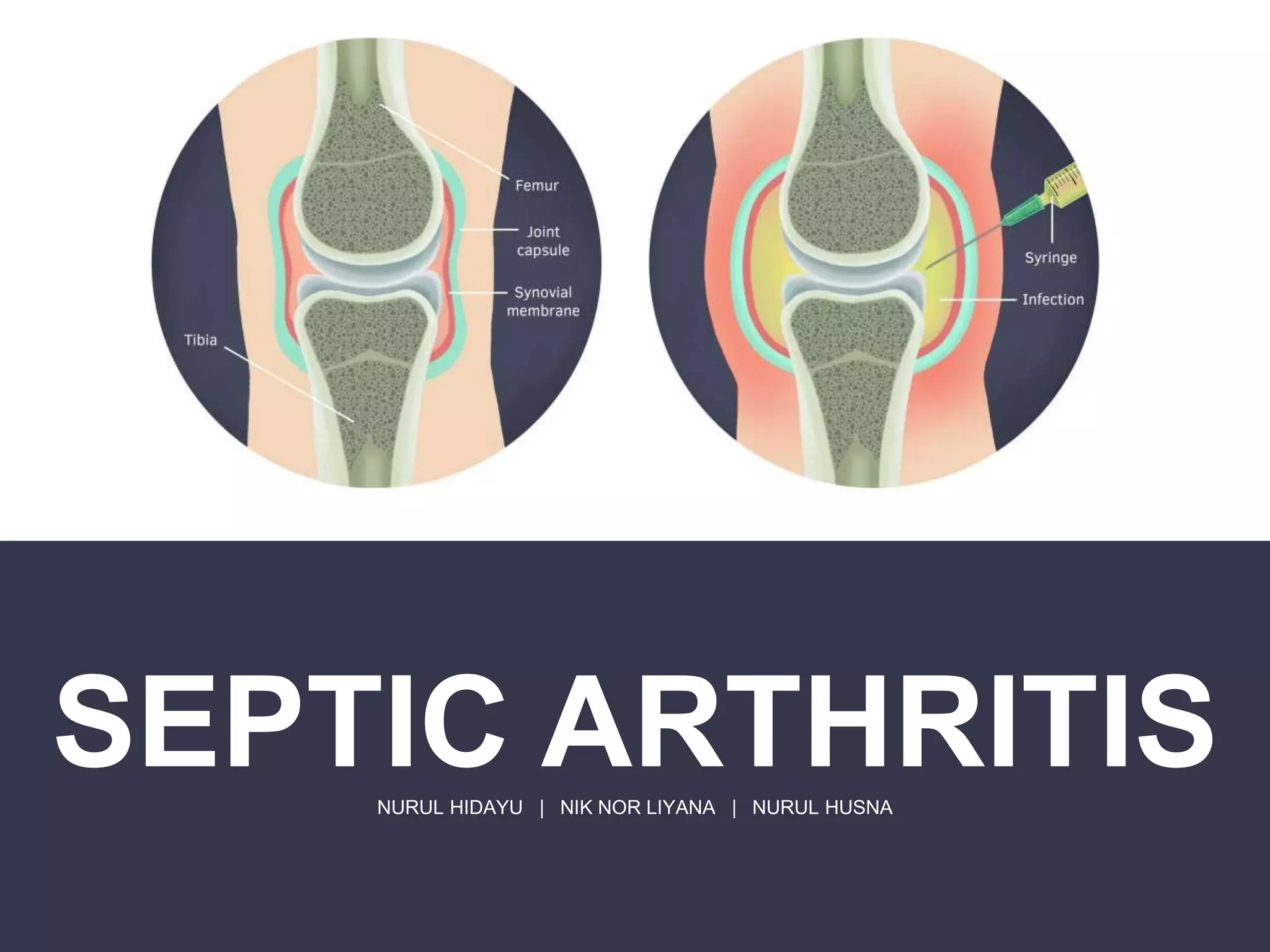 Septic Arthritis | PPTX