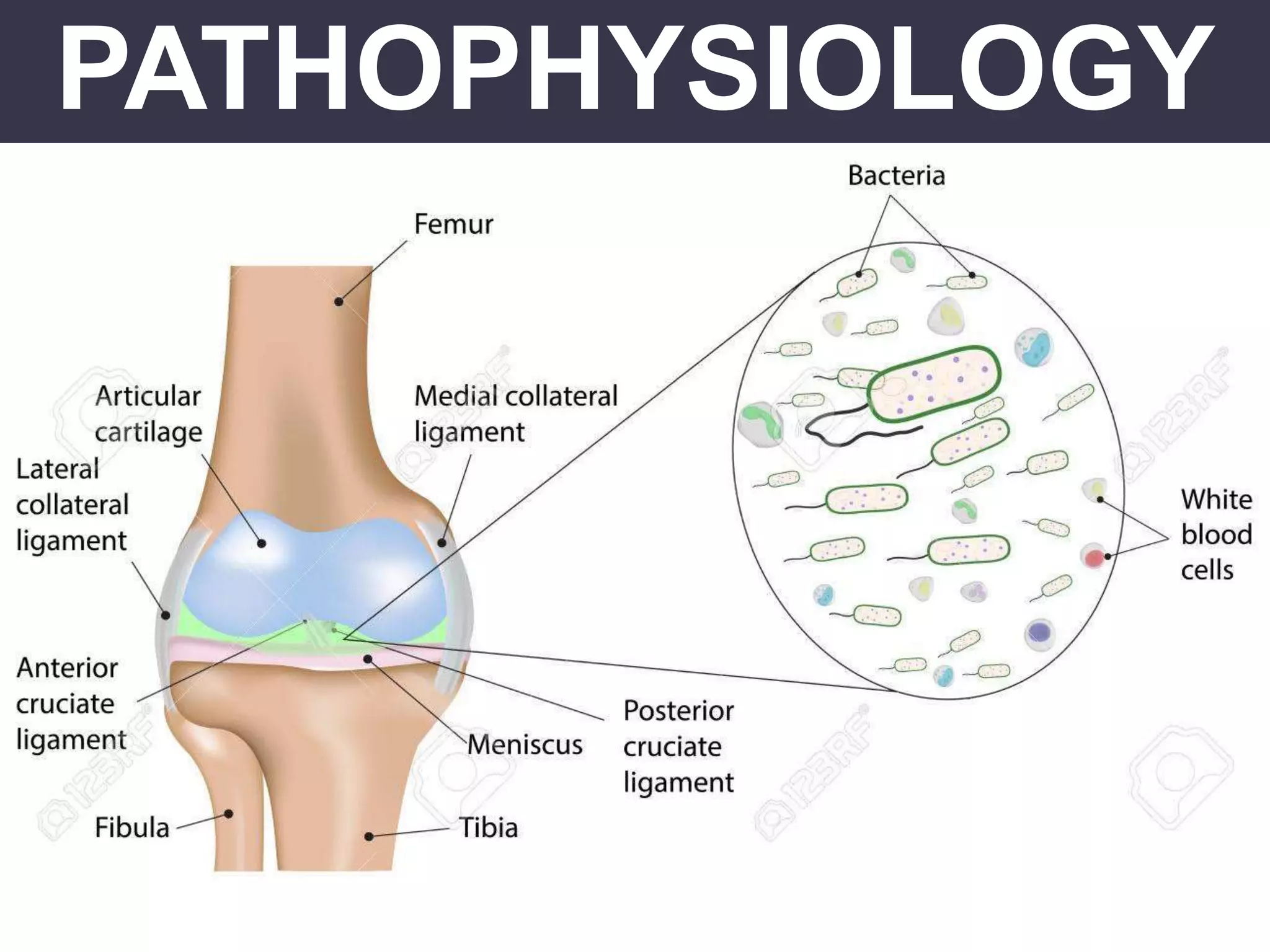 Septic Arthritis | PPTX