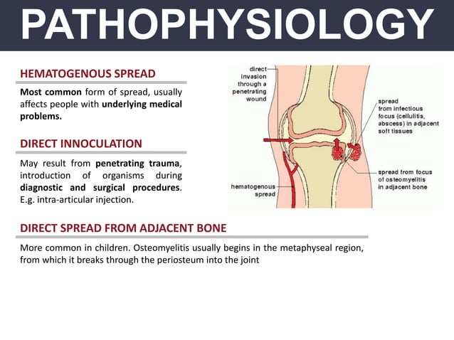 Septic Arthritis | PPT