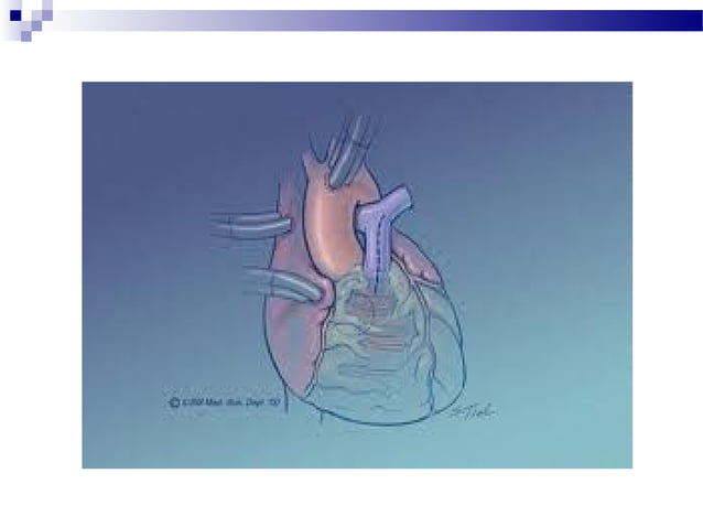 cannulation techniques during cpb | PPT | Heart and Cardiovascular ...