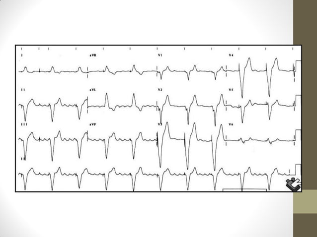 6. pacing induced cardiomyopathy | PDF