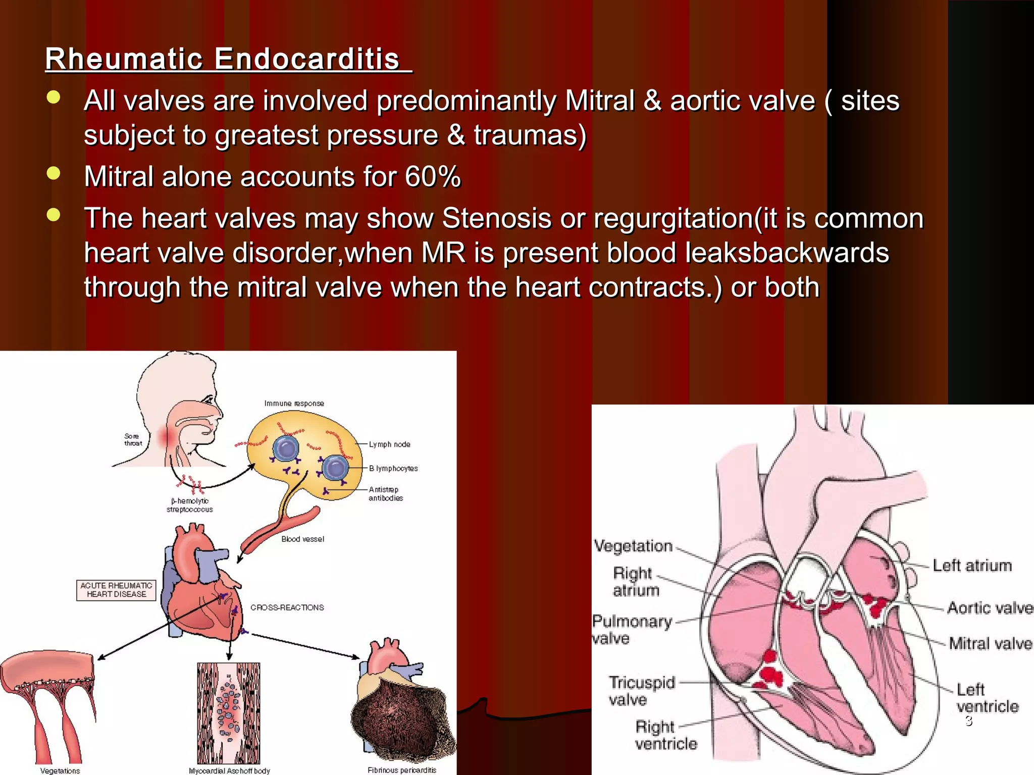 6.Infective endocarditis pathology | PPT