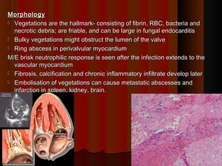 6.Infective endocarditis pathology | PPT