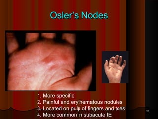 6.Infective endocarditis pathology | PPT