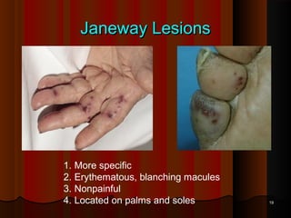 6.Infective endocarditis pathology | PPT