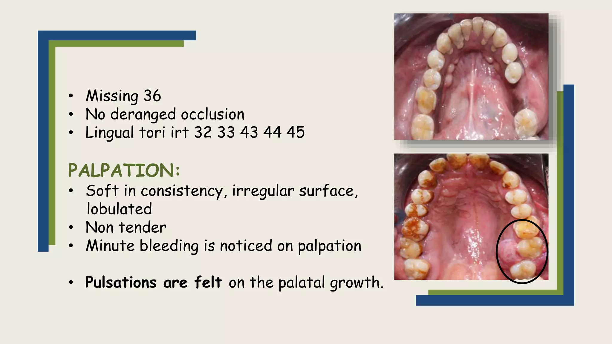 Pyogenic granuloma | PPTX