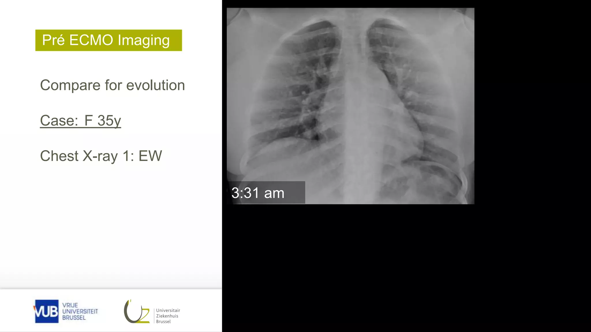 6. radiologic imaging in ecmo #beach2019 (nieboer) | PPT