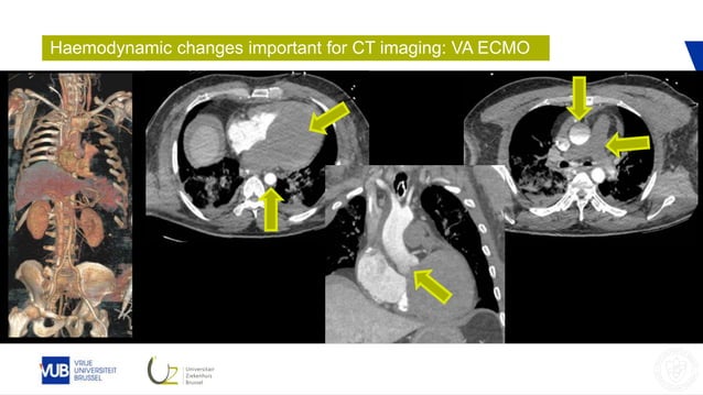 6. radiologic imaging in ecmo #beach2019 (nieboer) | PPT