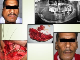 residual deformity correction in maxillofacial trauma | PPTX