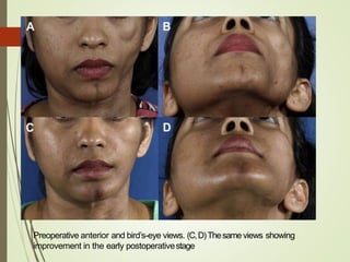 residual deformity correction in maxillofacial trauma | PPTX
