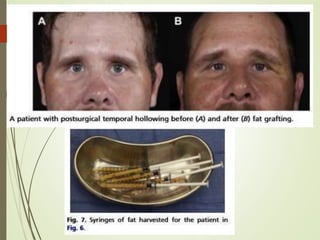 residual deformity correction in maxillofacial trauma | PPTX