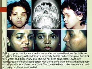 residual deformity correction in maxillofacial trauma | PPTX