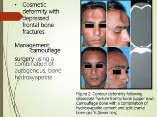 residual deformity correction in maxillofacial trauma | PPTX