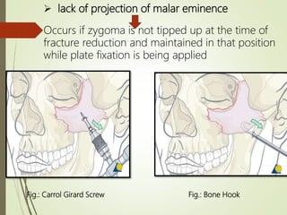 residual deformity correction in maxillofacial trauma | PPTX