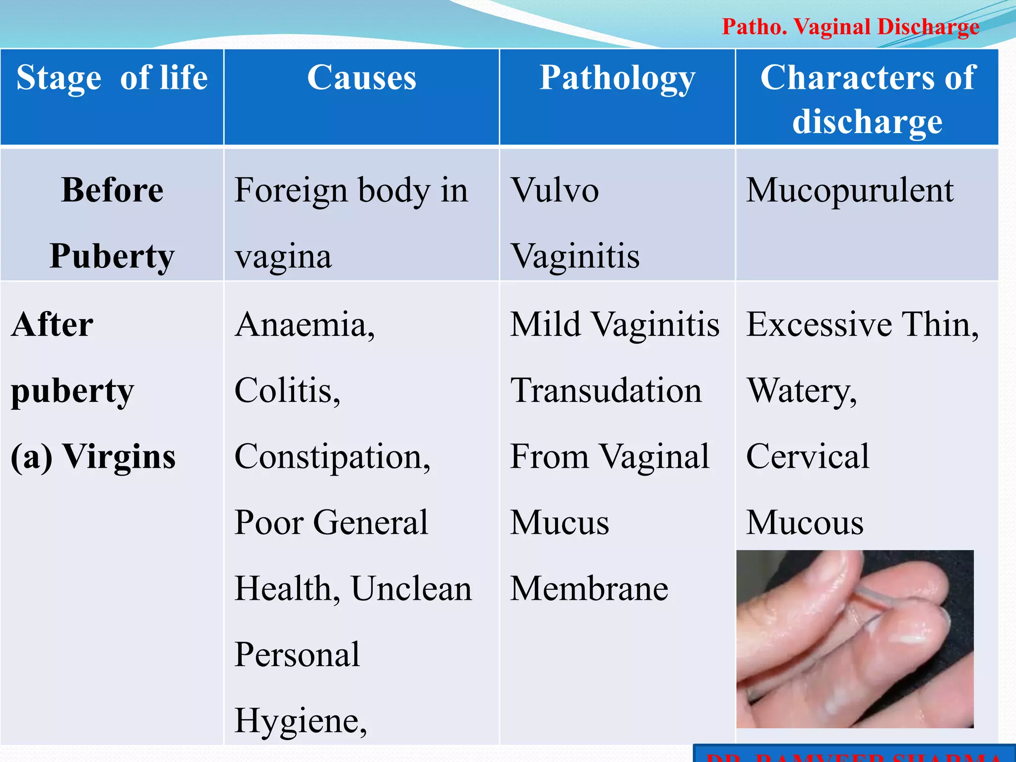 Vaginal Discharge, Pathological Leucorrhoea, Vaginal defense mechanism ...