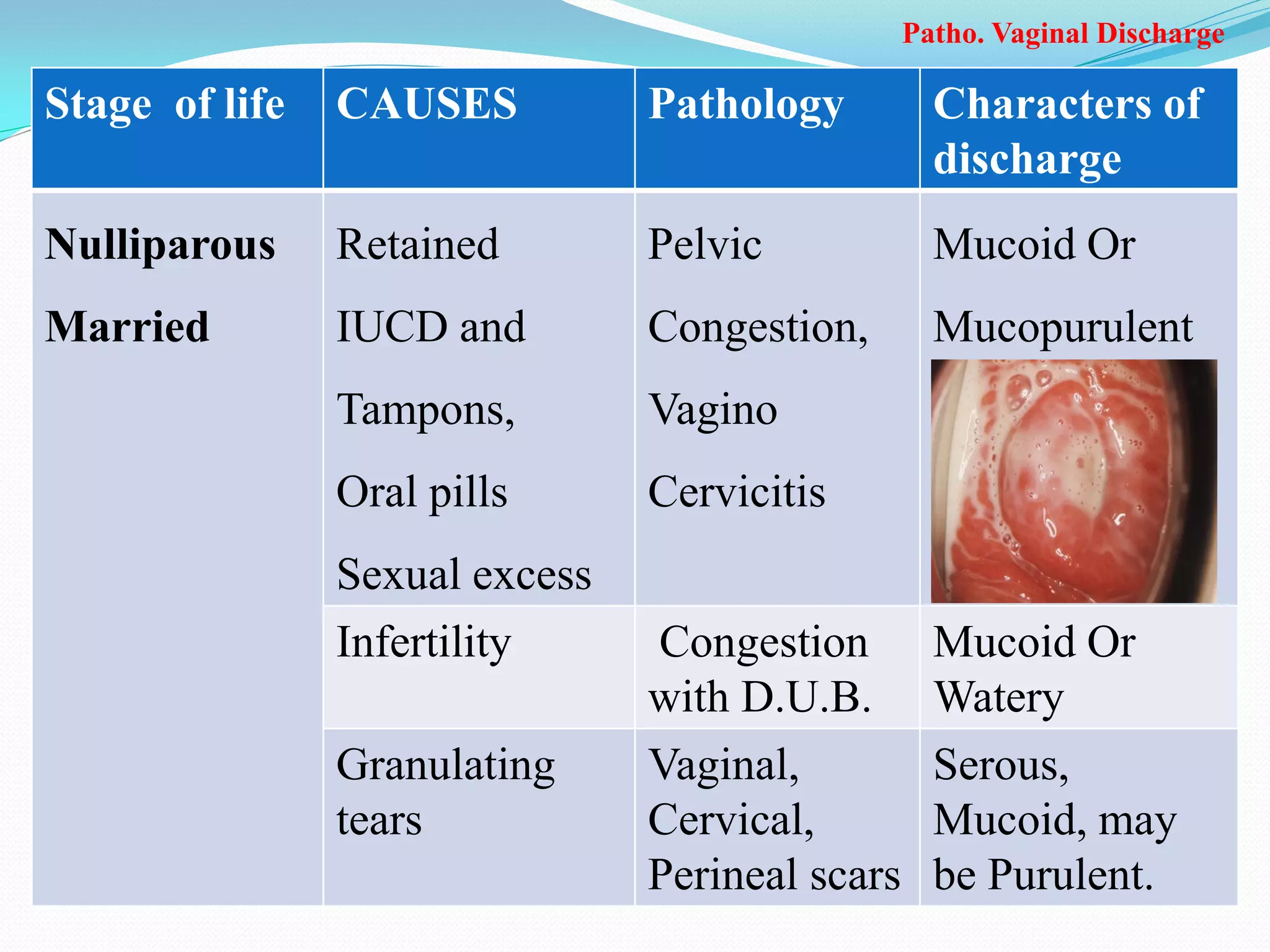 Vaginal Discharge, Pathological Leucorrhoea, Vaginal defense mechanism ...