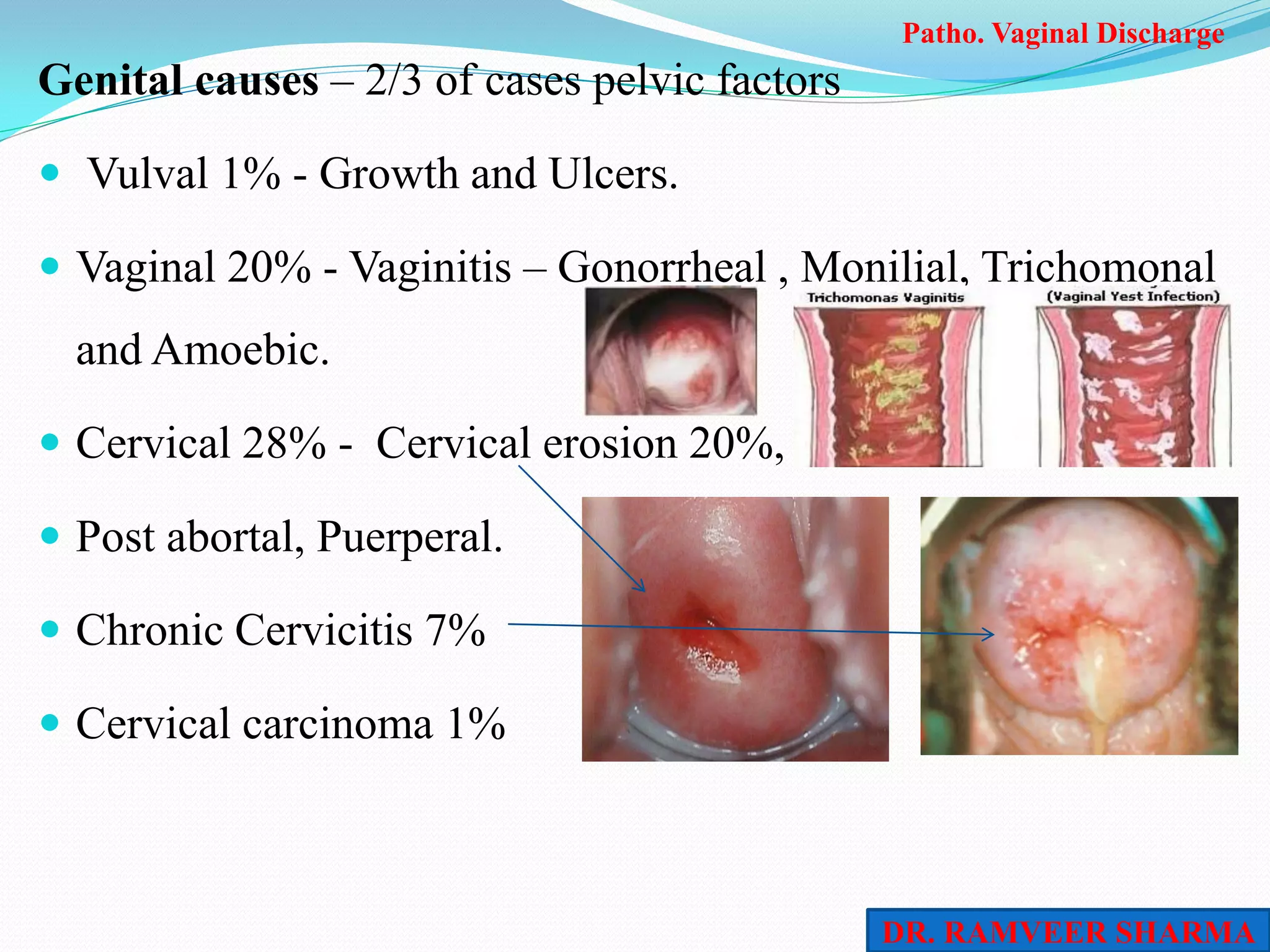 Vaginal Discharge, Pathological Leucorrhoea, Vaginal defense mechanism ...