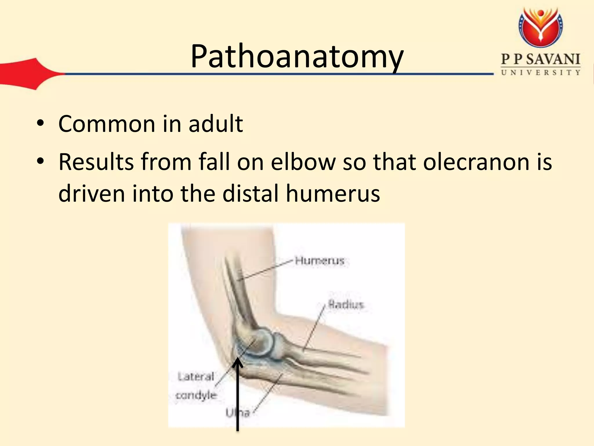 6. Humerus lower end fractures | PPTX