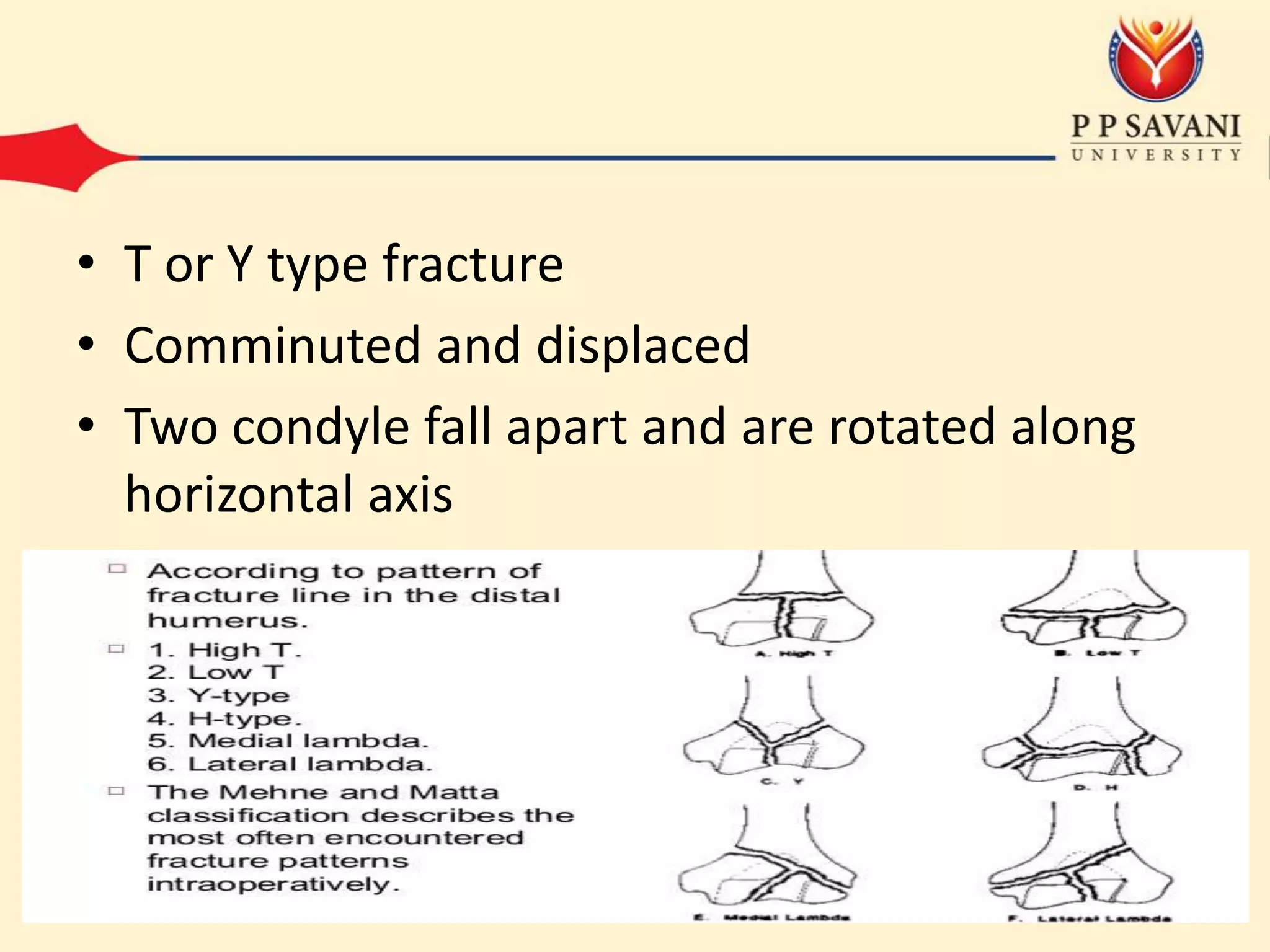 6. Humerus lower end fractures | PPTX