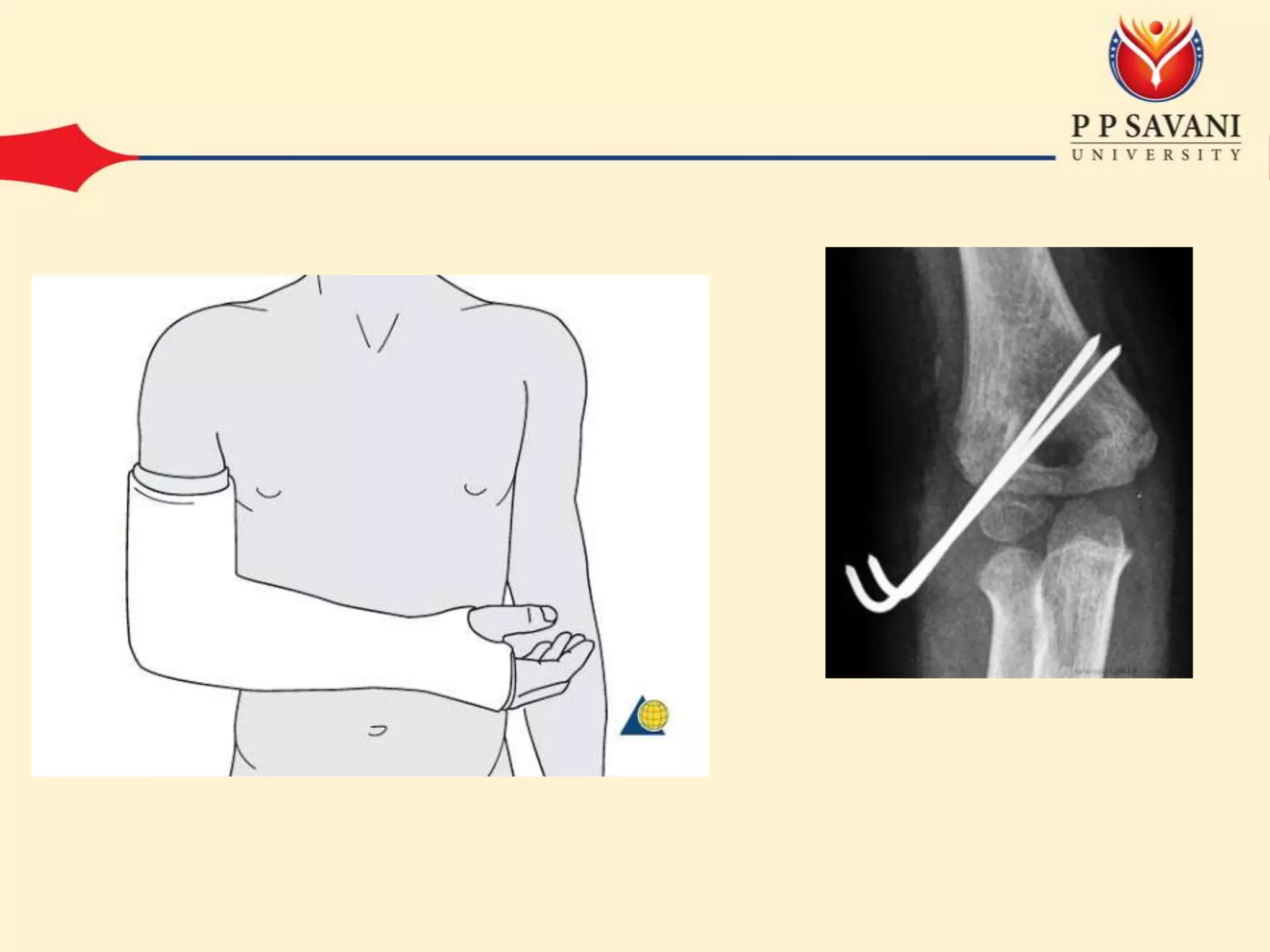 6. Humerus lower end fractures | PPTX