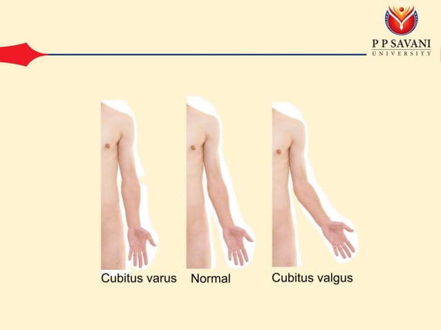6. Humerus lower end fractures | PPTX | Death, Injury, or Military ...
