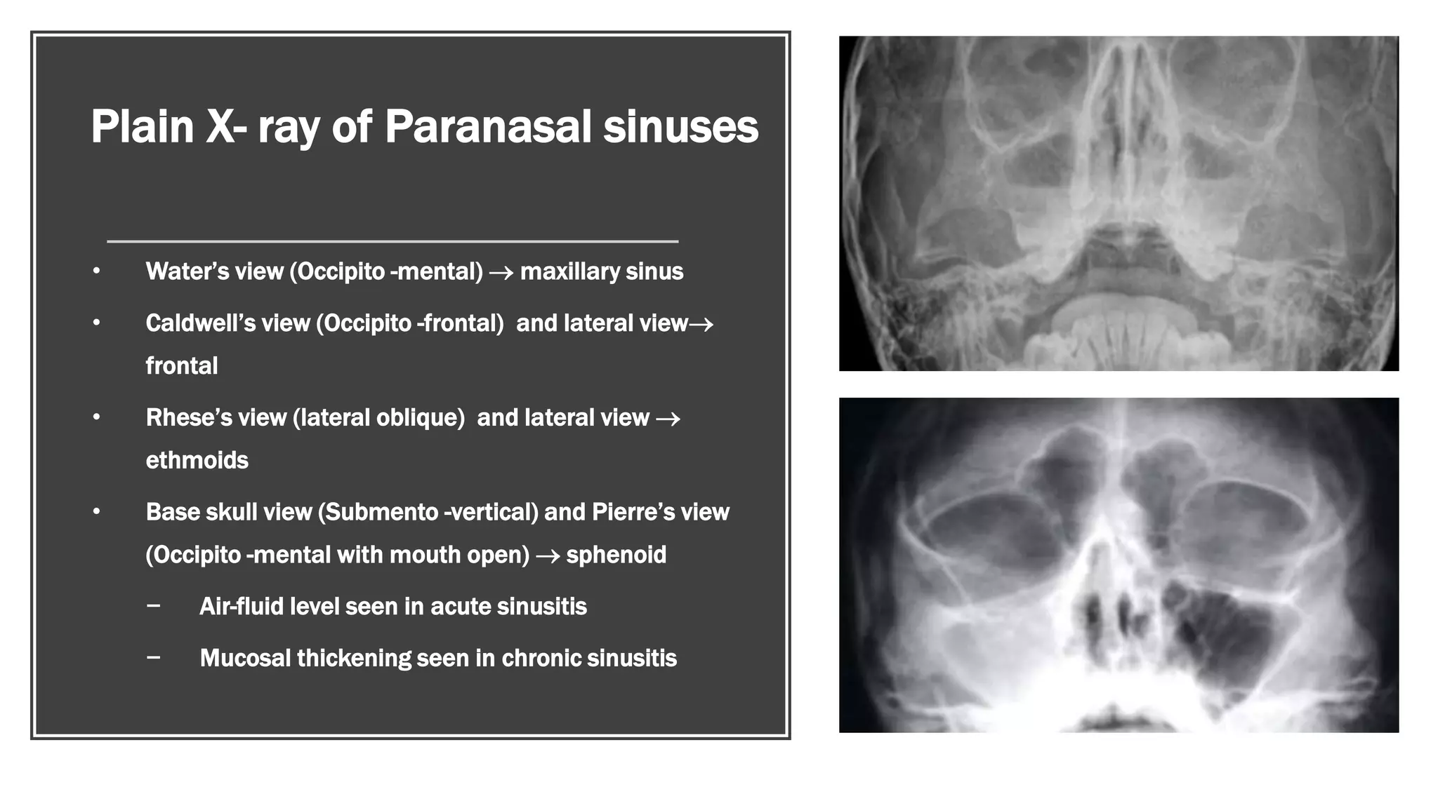 Rhinosinusitis: clinical features and diagnosis kk | PPTX
