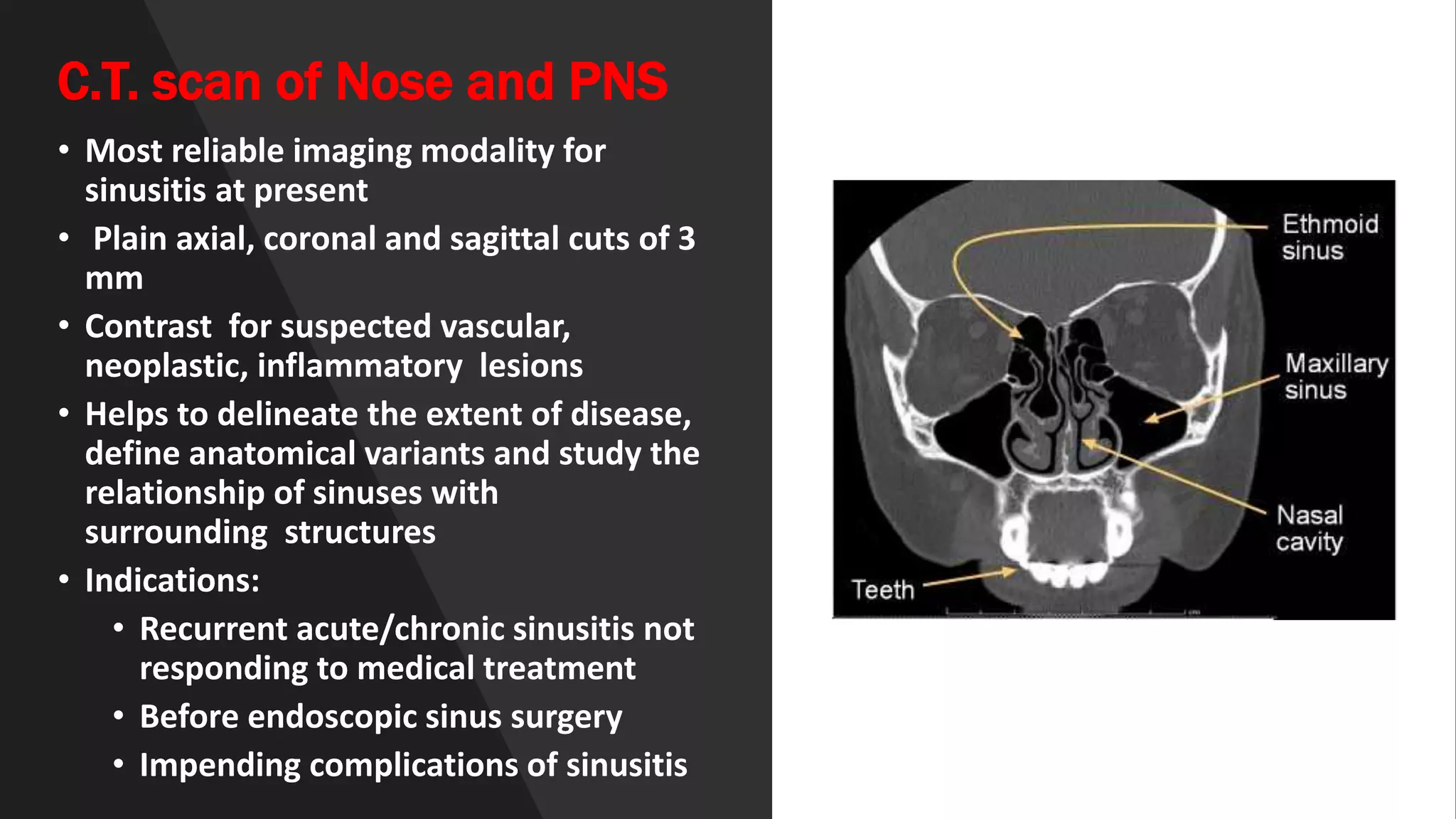 Rhinosinusitis: clinical features and diagnosis kk | PPTX