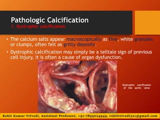 Pathologic Calcification by rohit kumar trivedi | PPTX