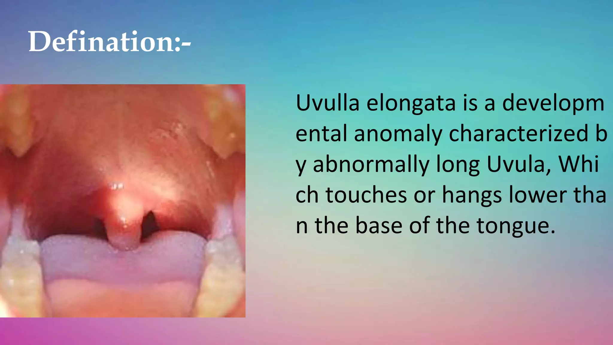 uvula elongata | Anomalies of lips and palate |Developmental anomalies ...
