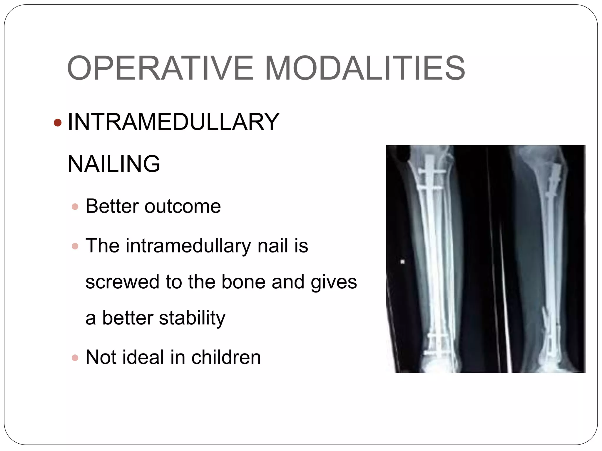 Fracture shaft of tibia | PPTX