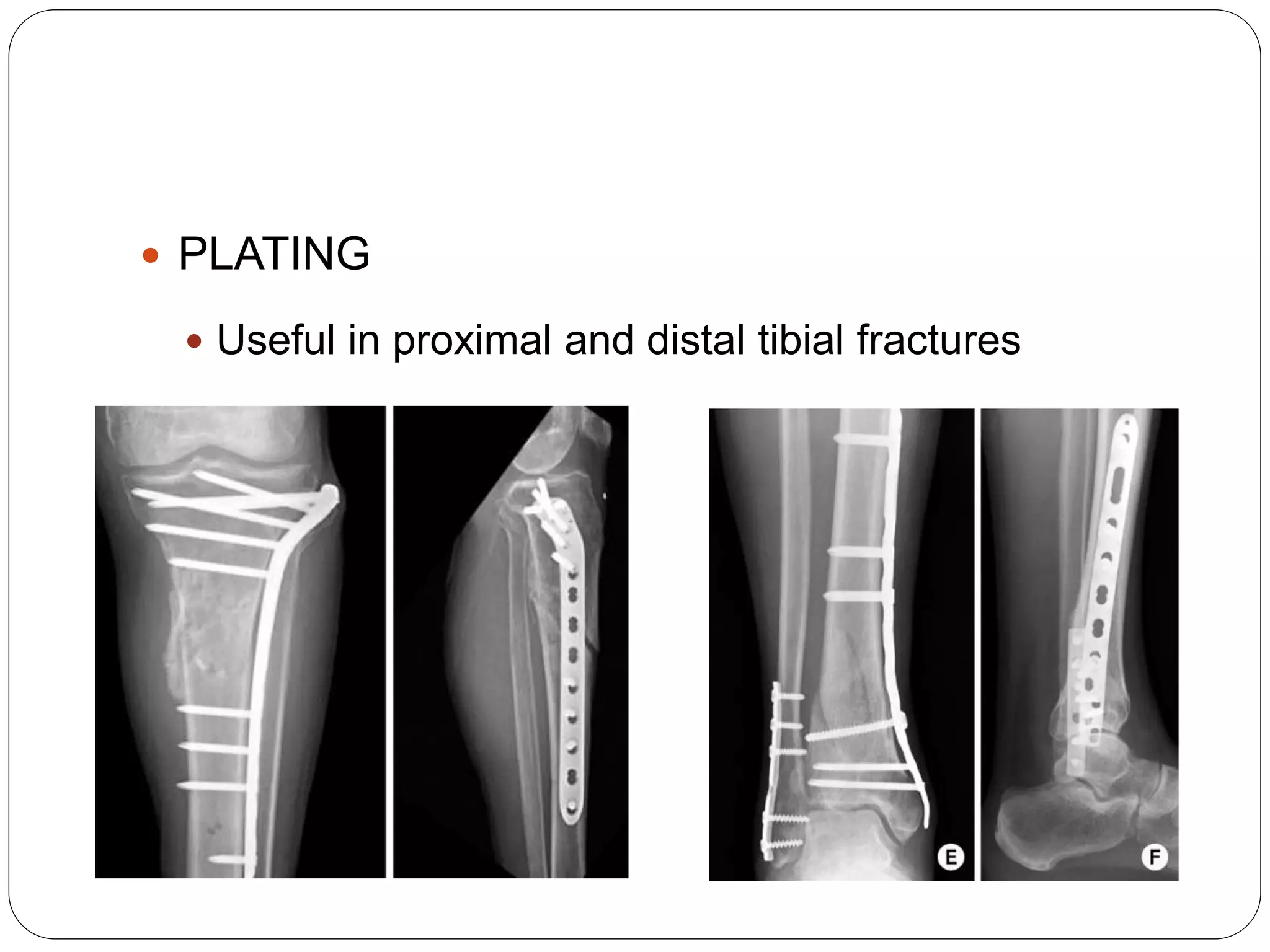 Fracture shaft of tibia | PPTX