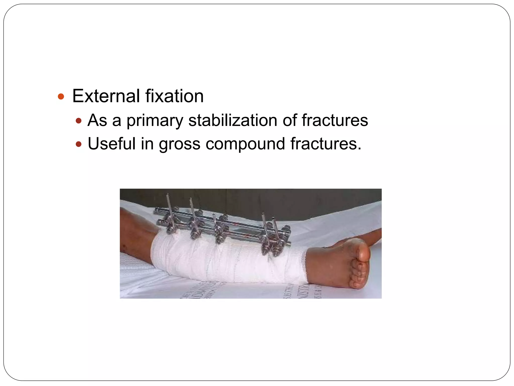 Fracture shaft of tibia | PPTX