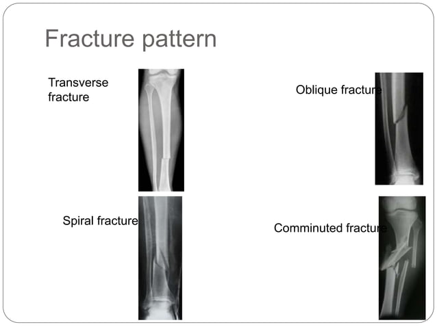 Fracture shaft of tibia | PPTX