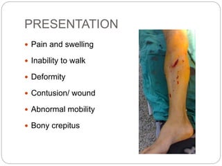 Fracture shaft of tibia | PPTX