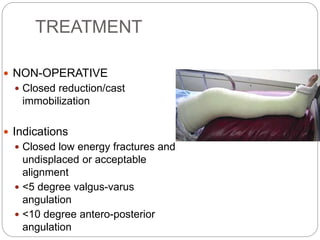 Fracture shaft of tibia | PPTX