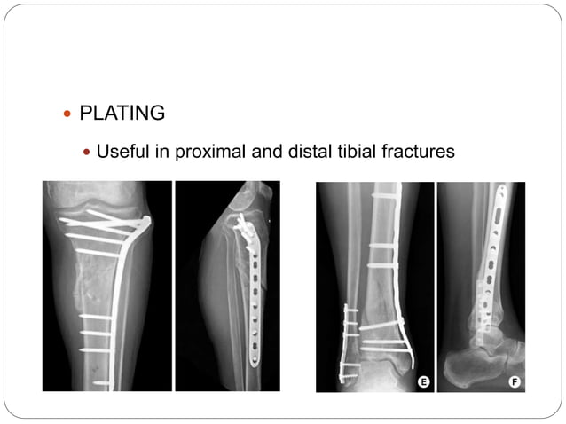 Fracture shaft of tibia | PPTX