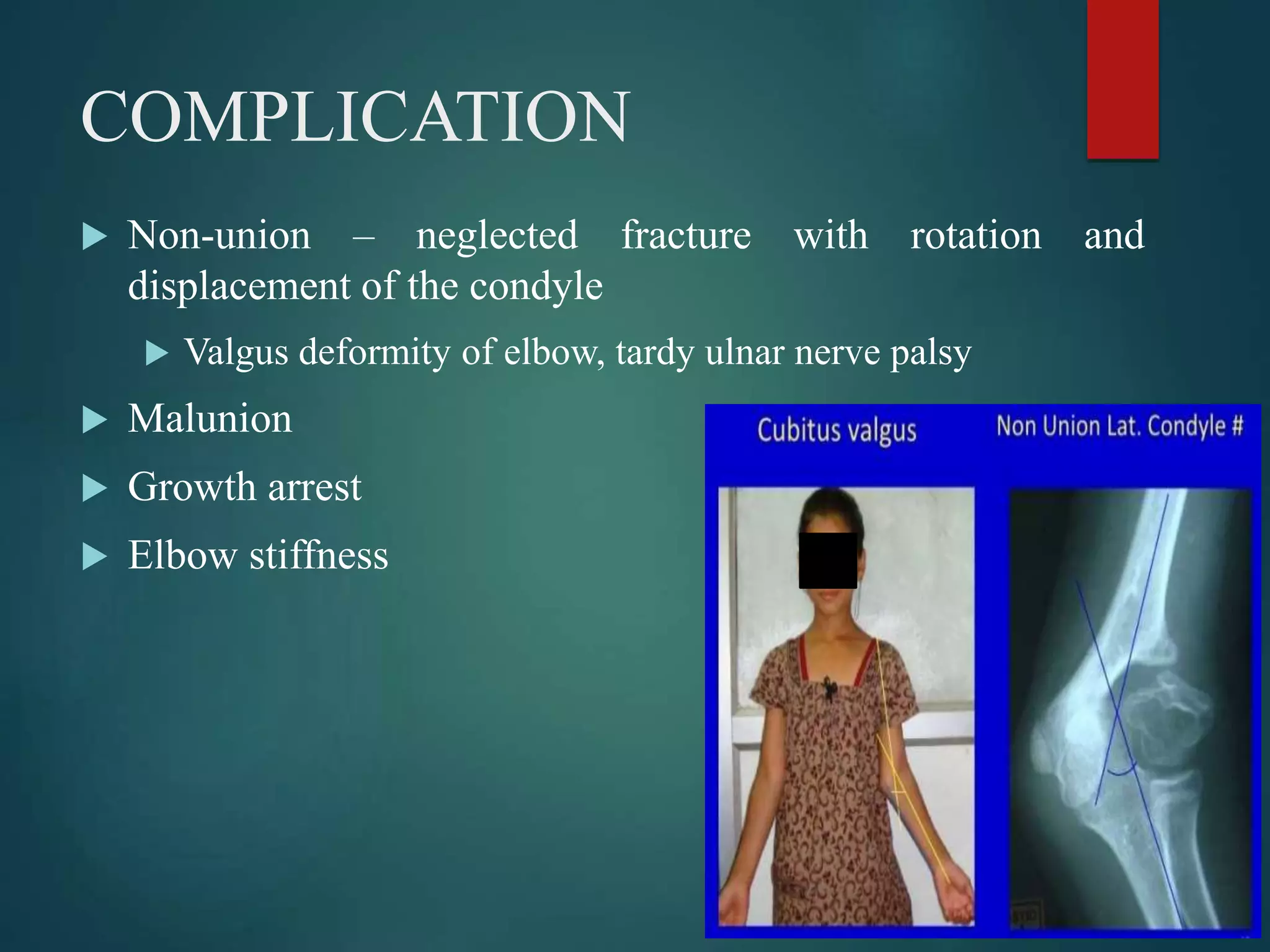 Lateral condyle fracture humerus | PPTX