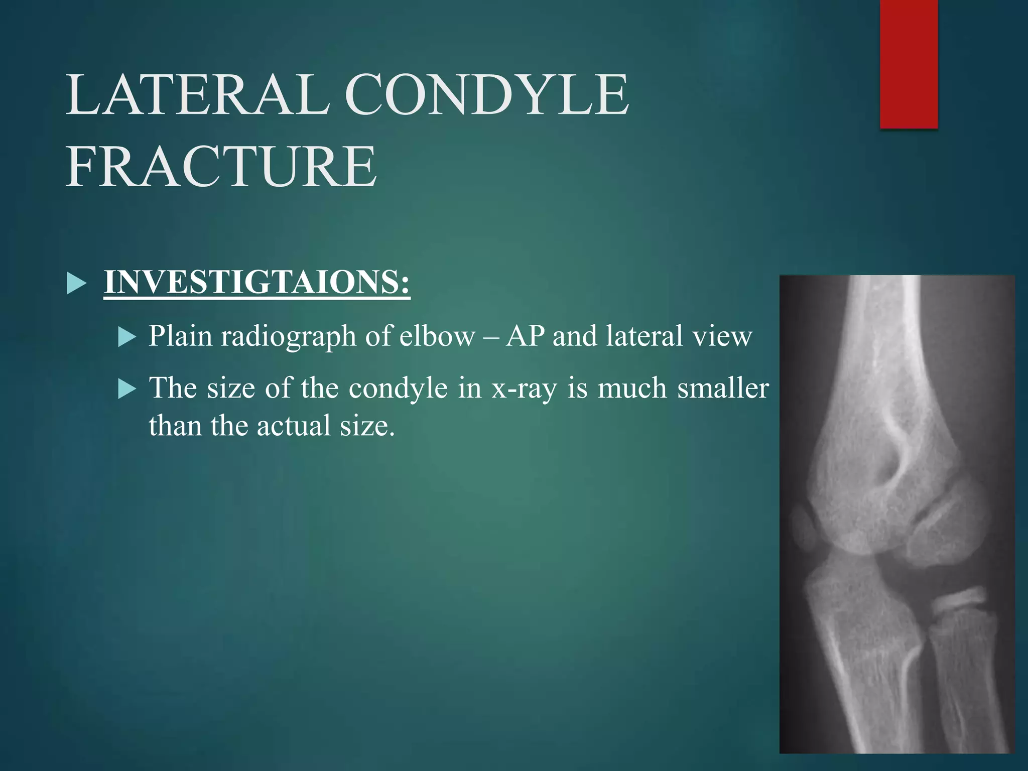 Lateral condyle fracture humerus | PPTX