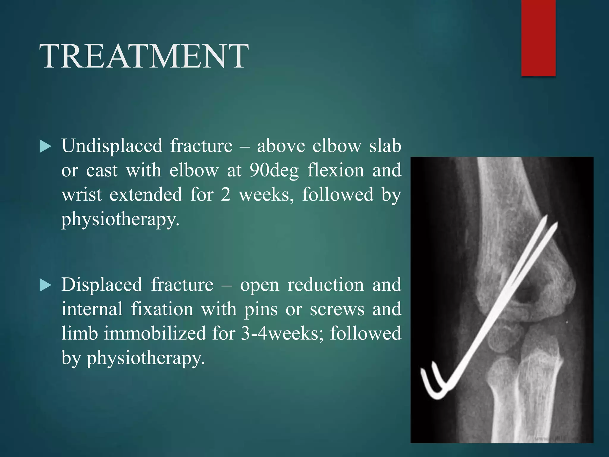 Lateral condyle fracture humerus | PPTX